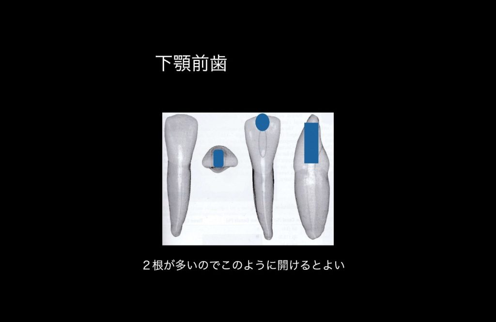 【臨床力を高める！根管治療の基礎から応用までの完全ガイドvol.2】根管治療成功の基盤を築く 髄室拡大から根管長測定までの重要ポイント – Dentwave（デントウェーブ）